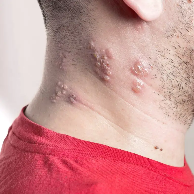 The Connection Between Shingles and Stress: Causes, Symptoms, and ...
